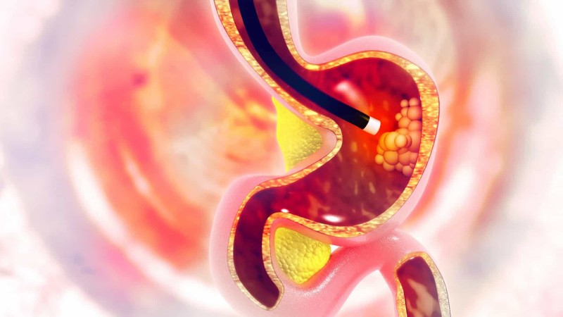 Endoscopía Quito - Estudios de Imagen Digestiva - Dr. Xavier Obando